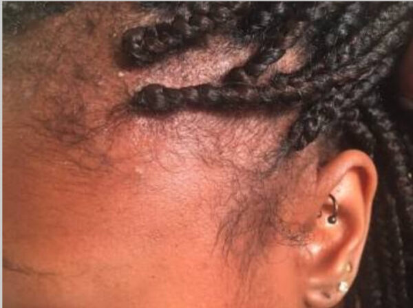 Braid bumps (what are they and how to tackle them)